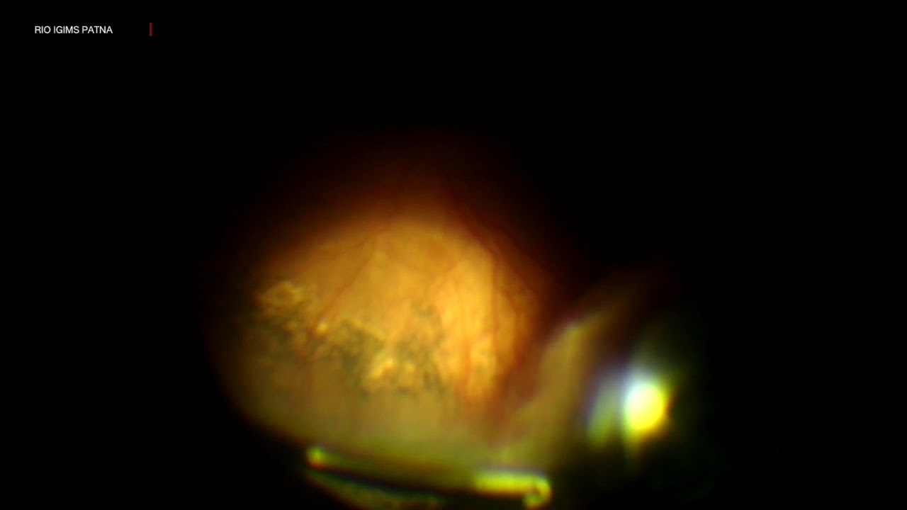 ROP STAGE 4A - YouTube