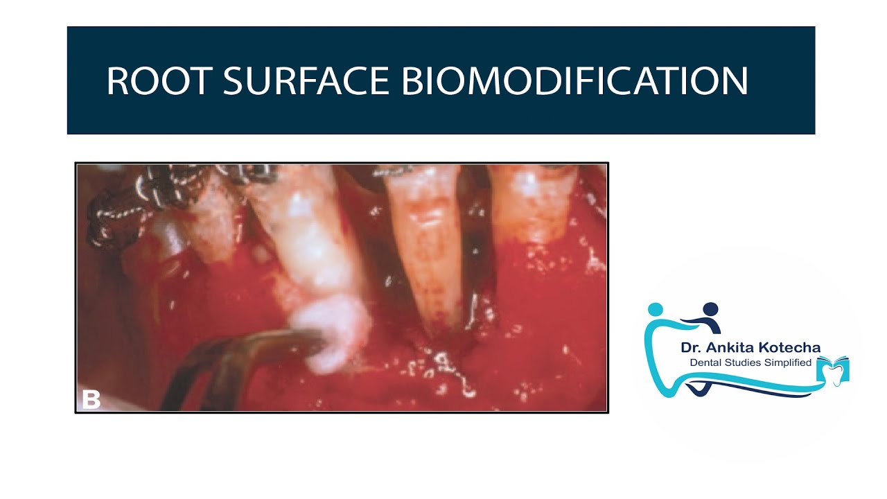 ROOT SURFACE BIOMODIFICATION for root coverage| Additive treatment ...