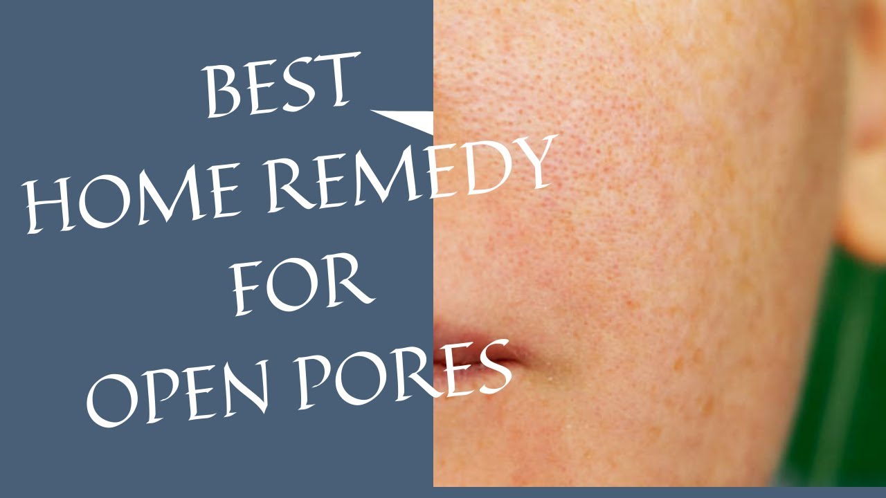 How to get rid of open pores on face | open pores home remedy | open ...