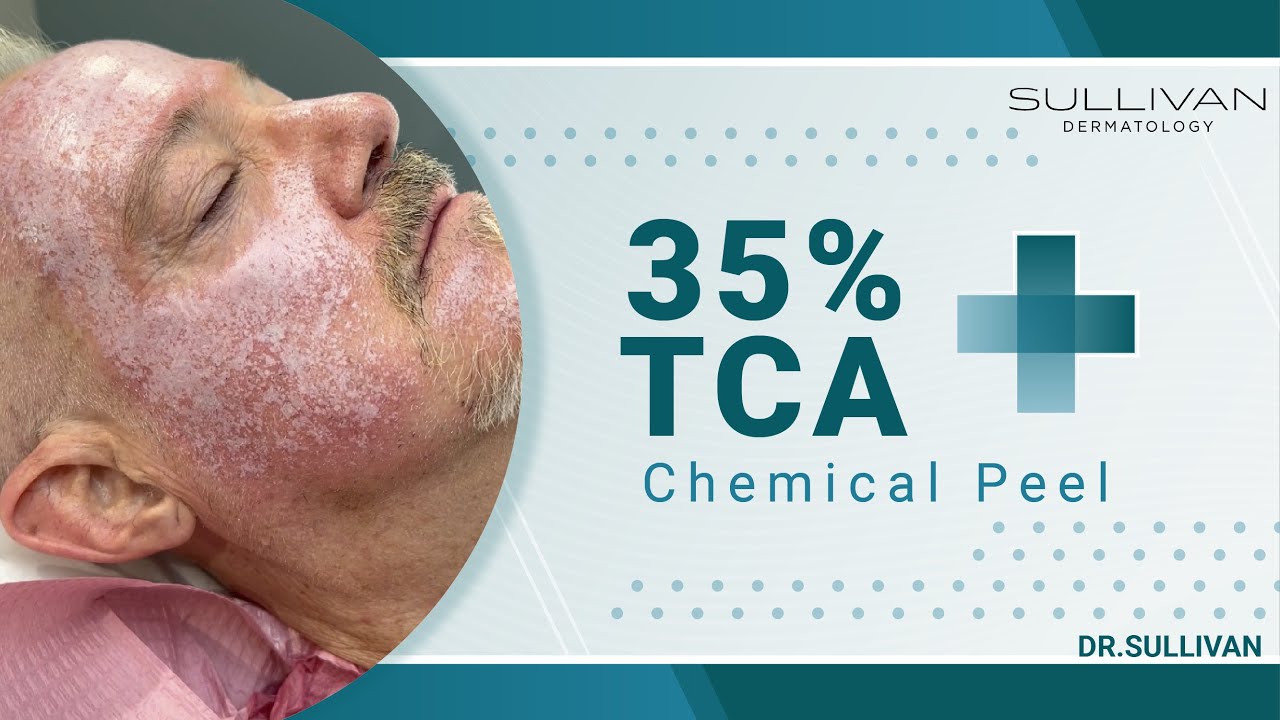 TCA Chemical Peel Unveiled: Transform Your Skin Today #chemicalpeels # ...