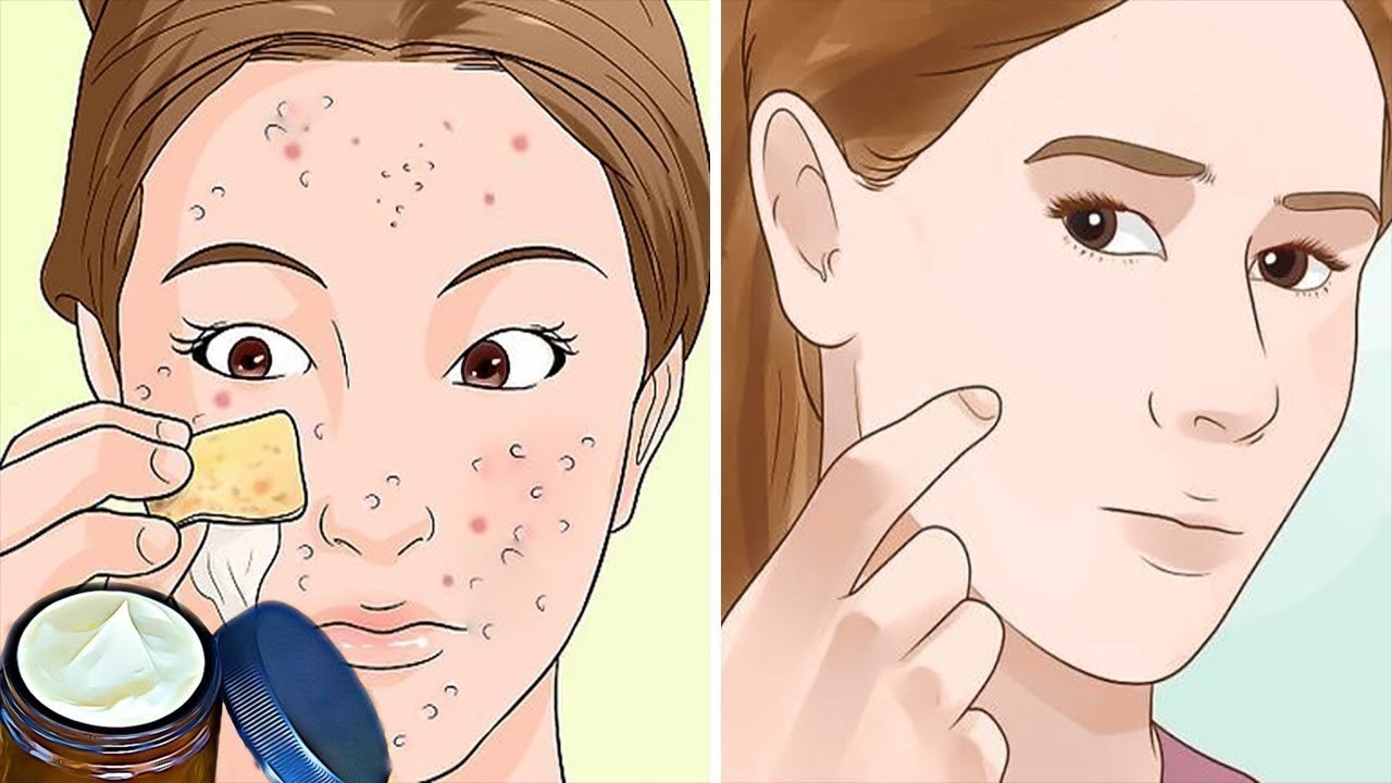 Como Quitar Las Pecas Del Rostro 🎄 Como Quitarme Las Pecas Dela Cara ...