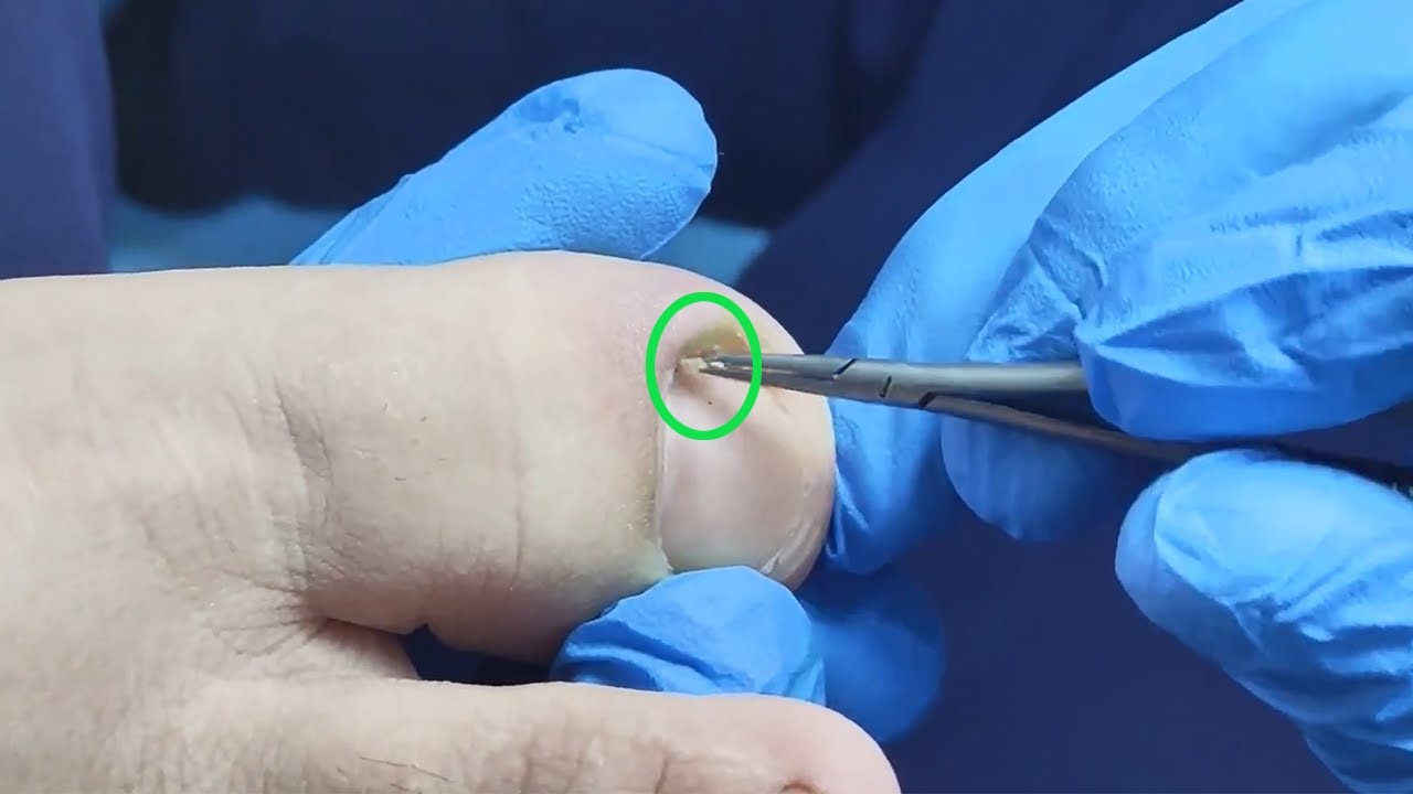Digging out deeply hidden ingrown toenail - YouTube