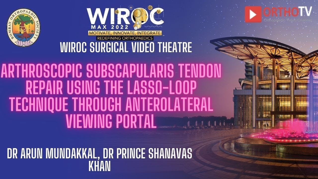 Arthroscopic Subscapularis Tendon Repair Using Lasso-Loop Technique Dr Arun M, Dr P Shanavas ...