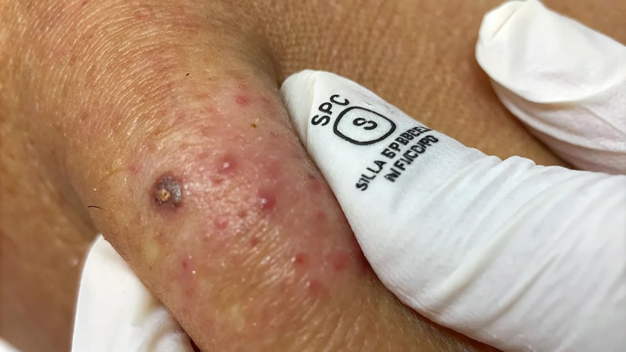 STOP Popping Pimples Like This and Get EXPERT Results Instead - YouTube