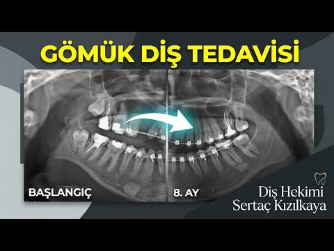 Gömük dişin ortodonti tedavisi ile sürdürülmesi videosu. Diş Hekimi Sertaç Kızılkaya