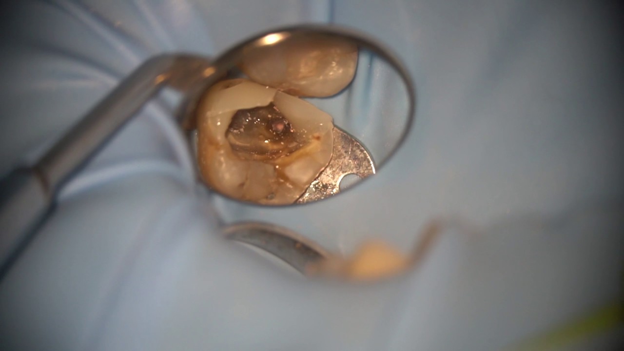 GP removal - YouTube