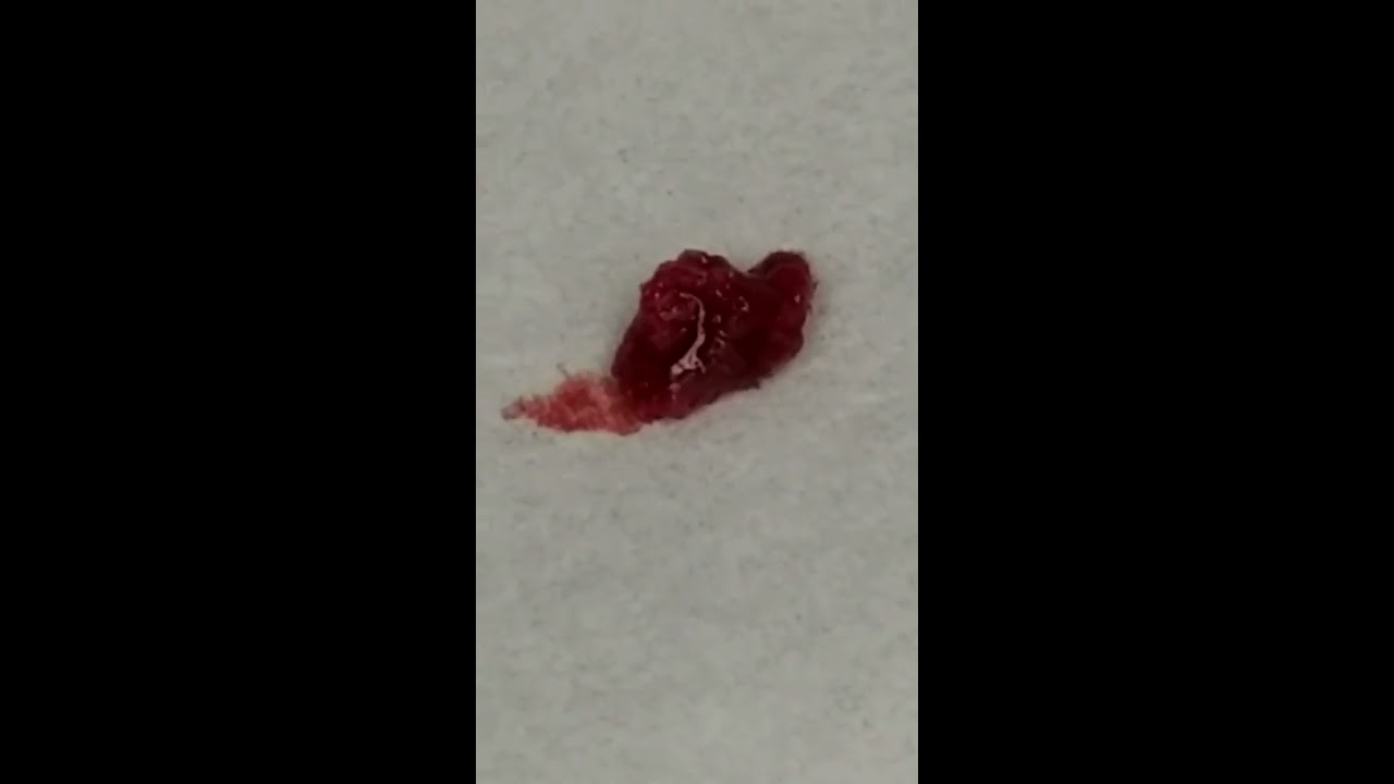 Cyst on ear - YouTube