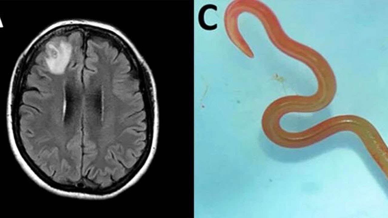 'Its Moving!' Shock after live worm is found inside woman's brain - YouTube