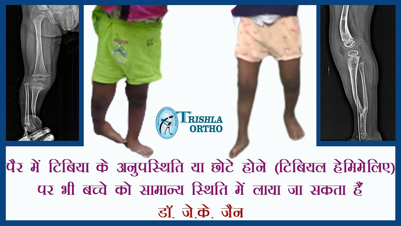 Tibial Hemimelia: Child with Congenital Tibial Hemimelia Begins Walking ...