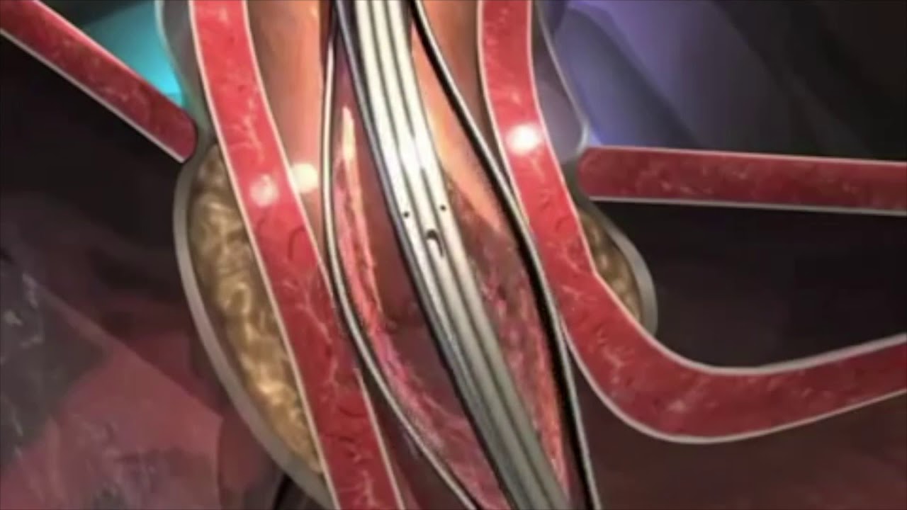 STRETTA- TERAPIA ENDOSCÓPICA ANTI-REFLUXO - YouTube