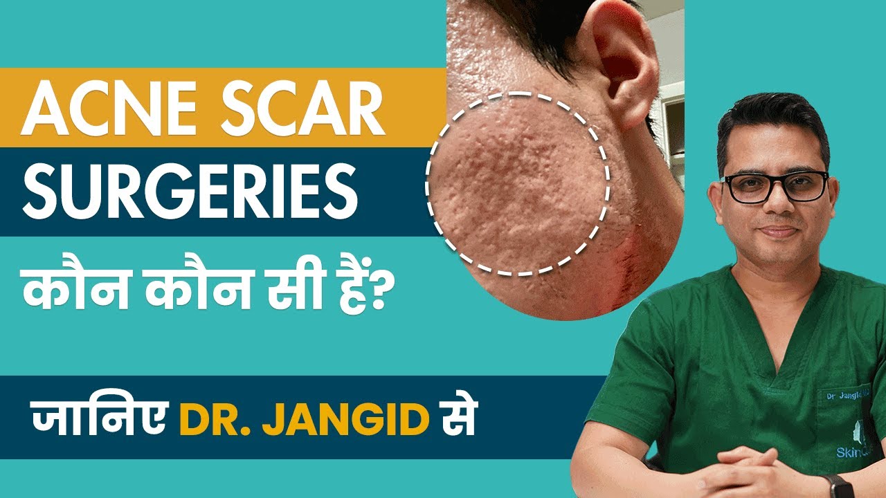 Types of Acne Scar Surgery Treatments and How Do They Work? Dr. Jangid ...