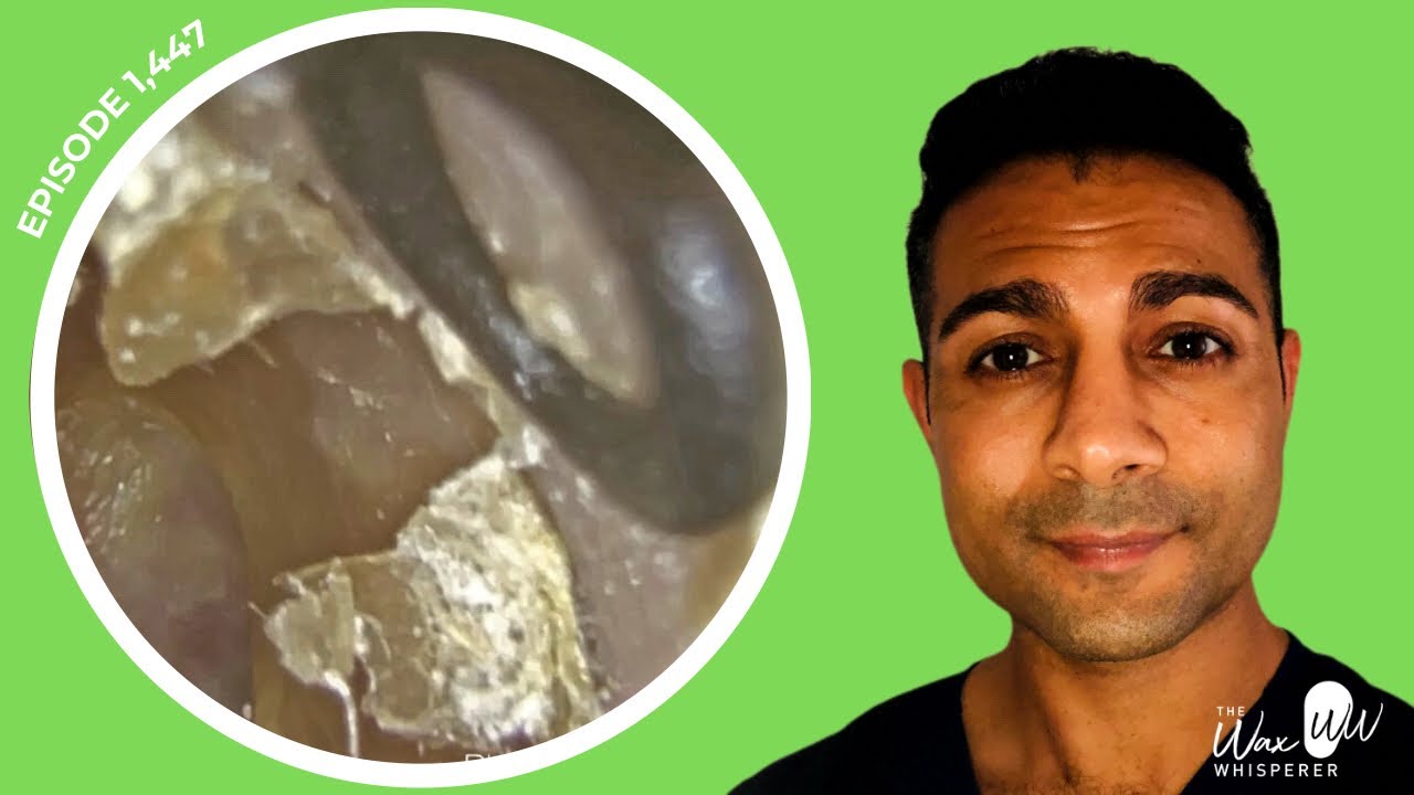 1,447 - Granular Myringitis Post Clearance of Otorrhea | Crusted Skin ...