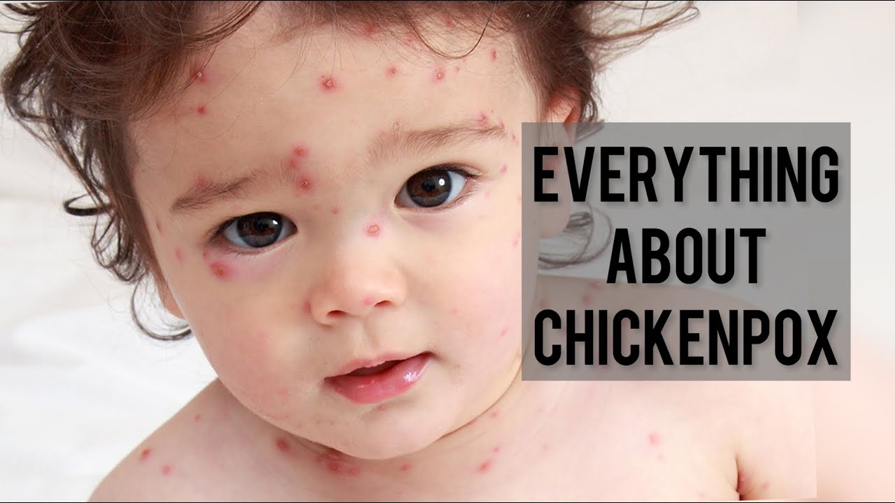 EVERYTHING you didn't know about CHICKENPOX - YouTube