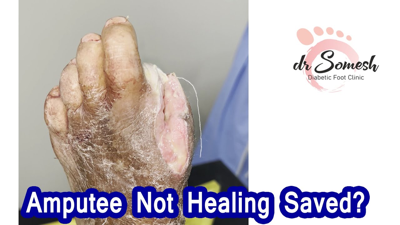 Gangrene Foot Amputation ? Before After Video #diabeticfoot # ...
