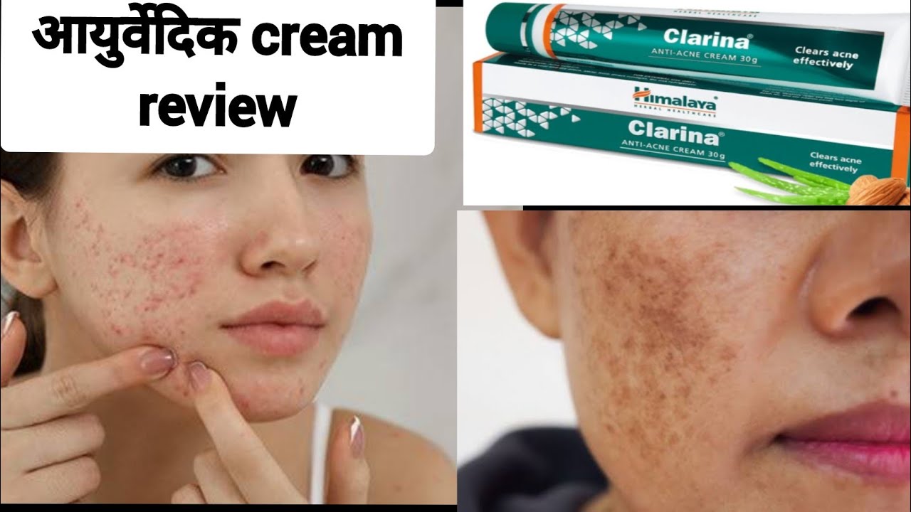 पिंपल्स,डाग, घालवा एका चुटकीत बघा या क्रिम चा इफेक्टhimalaya clarina ...