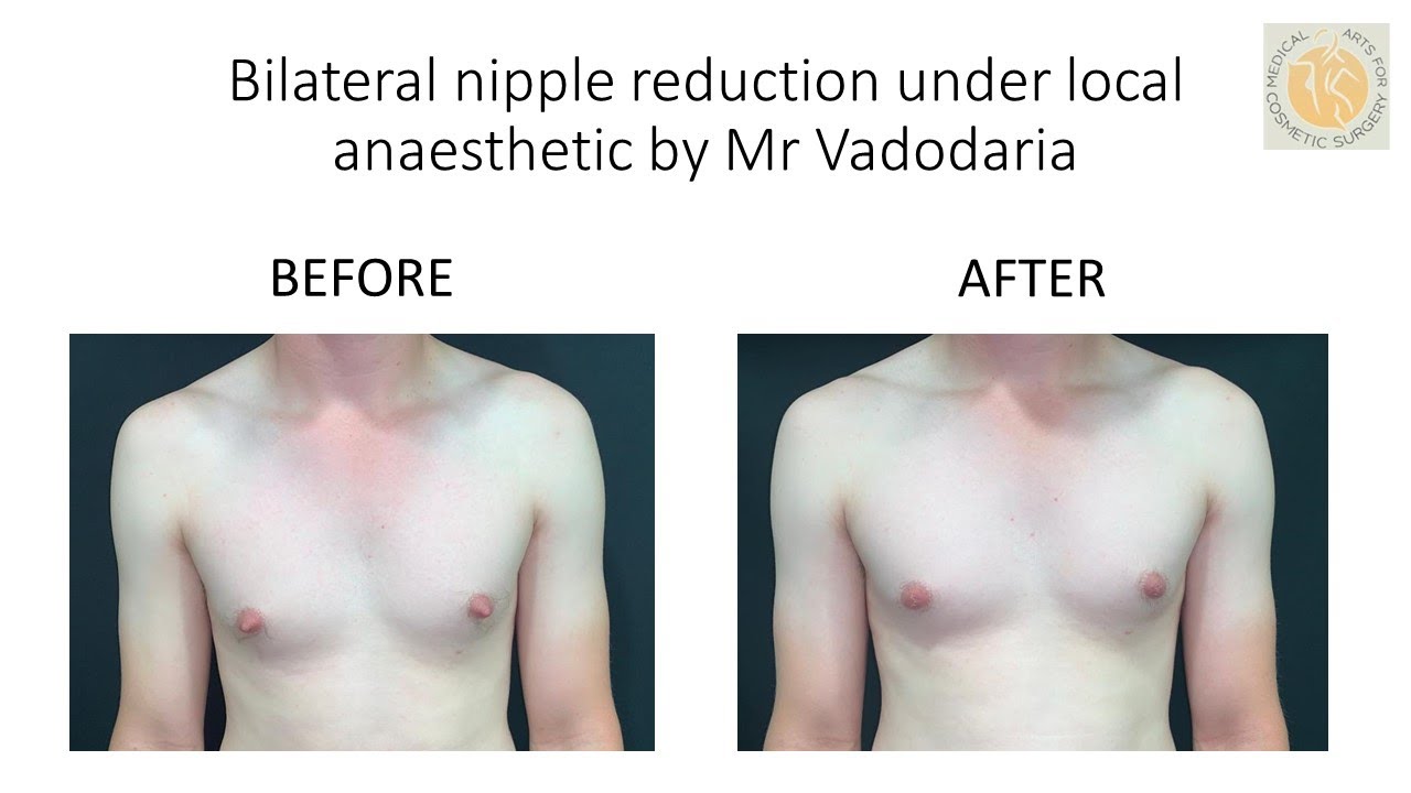 Bilateral Nipple Reduction Under Local Anaesthetic Youtube