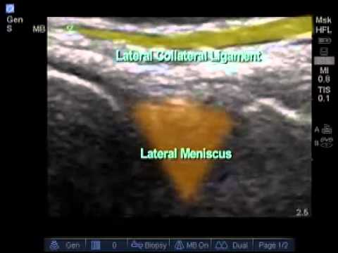 How to: Lateral Meniscus Ultrasound Exam - YouTube
