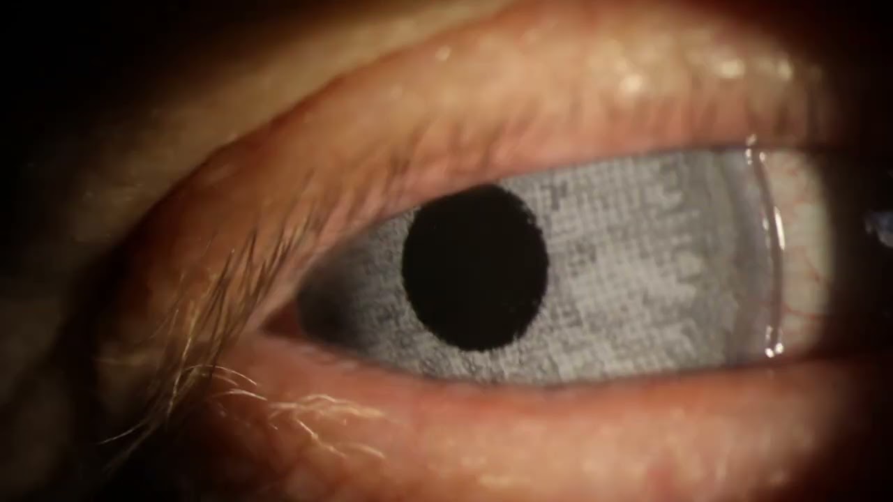 Prosthetic Contact Lens Painted to match Eye - YouTube