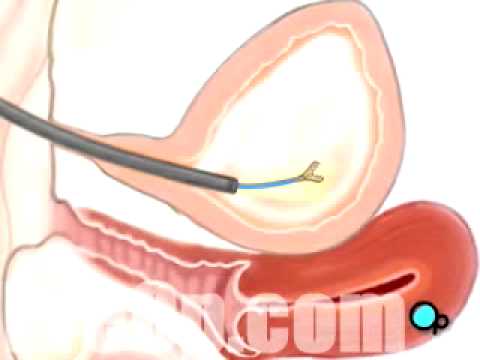 PreOp® Patient Education Cystoscopy Female Surgery 2 - YouTube