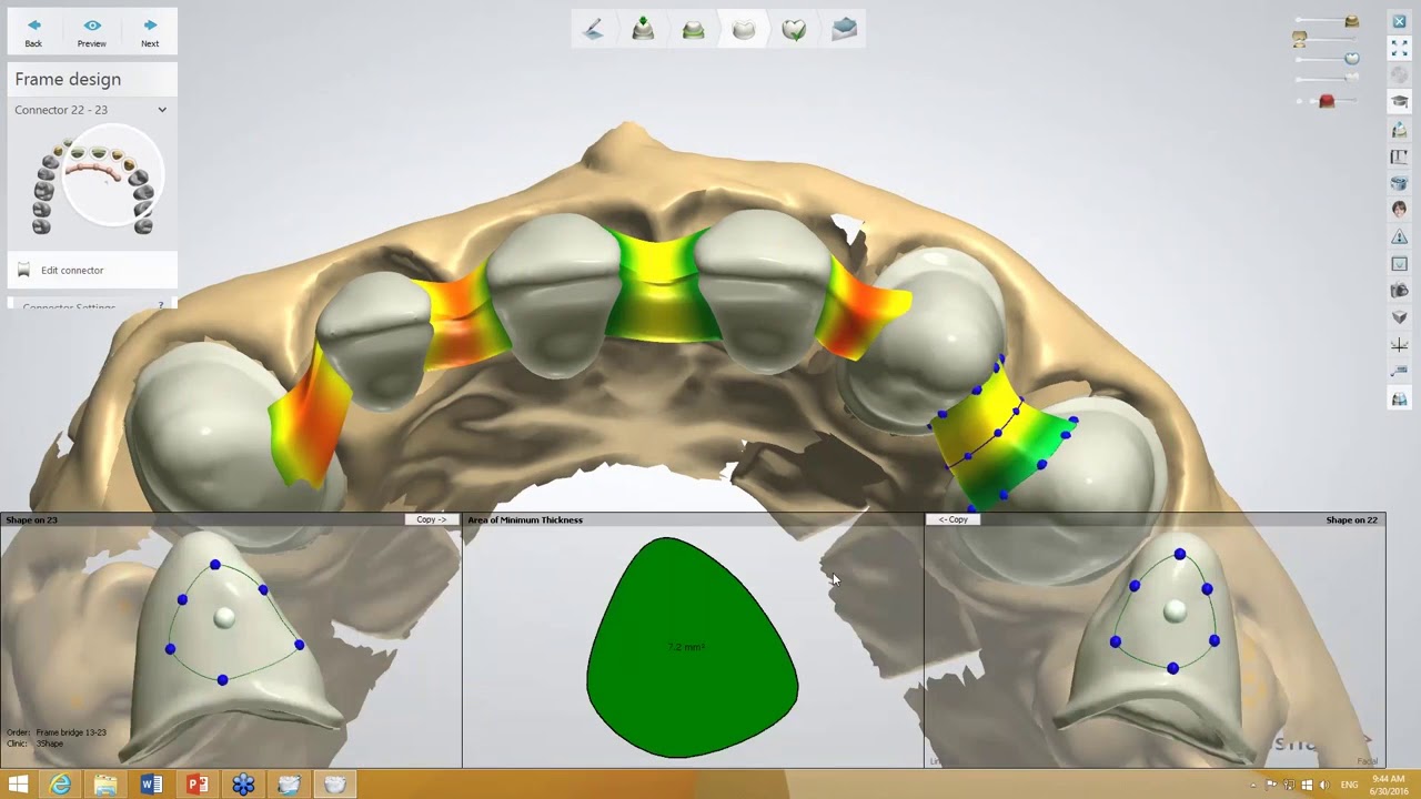 Dental system™ Frame bridges - YouTube
