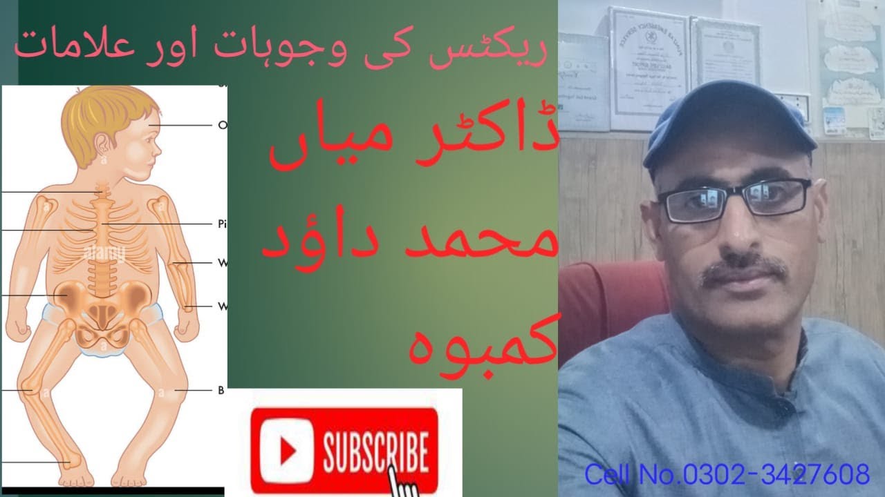 Rickets causes and symptoms - YouTube