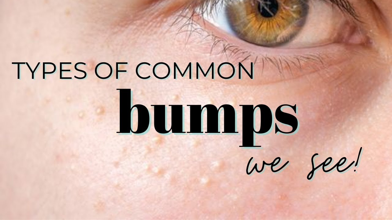 Types of common bumps we see - YouTube