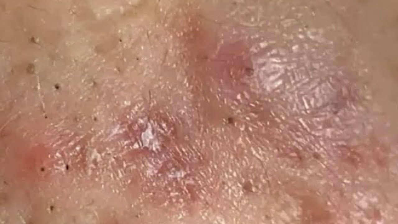 RELAXE WITH PIMPLE FANS PIMPLES TREATEMENT #0032 - YouTube