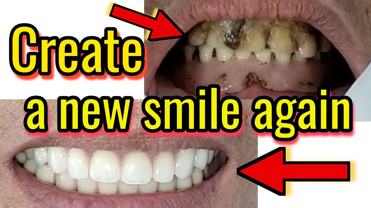 Create a new smile again with COMPLETE DENTURES - YouTube