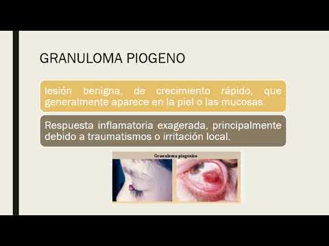 COMPLICACIONES EN QX DE PTERIGION, USO DE MITOMICINA C Y GRANULOMA ...