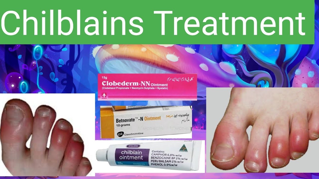 Chilblains Treatment | सर्दियों मैं हाथ पैरों में सूजन क्यों होती है ...