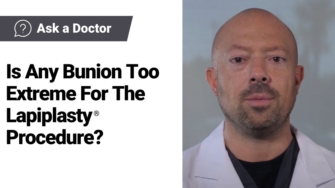 Is Any Bunion Too Extreme For The Lapiplasty® Procedure? | Ask A ...