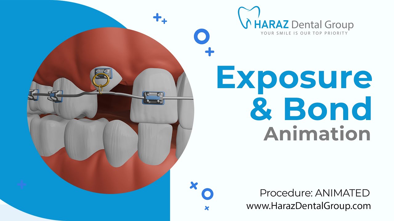 Exposure and Bonding: The Essential Dental Procedure Explained by HARAZ ...