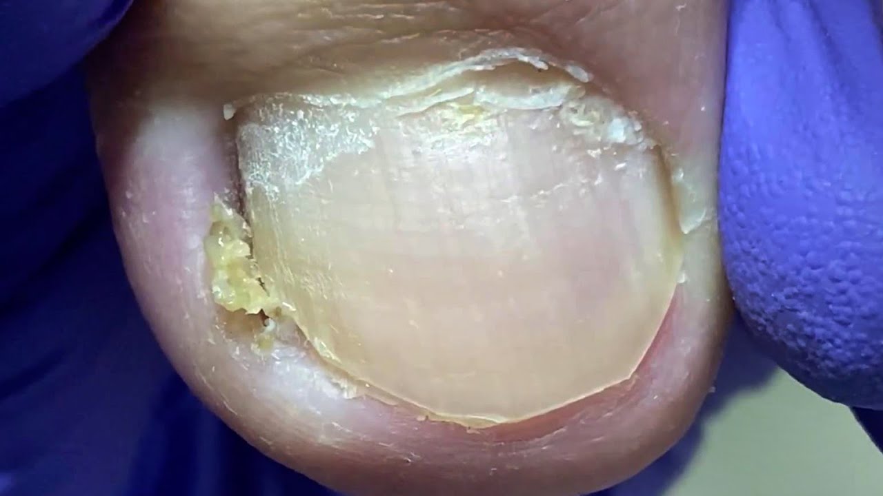 Nails infected with fungus, dig out hooks hidden underneath【Doctor Liu ...