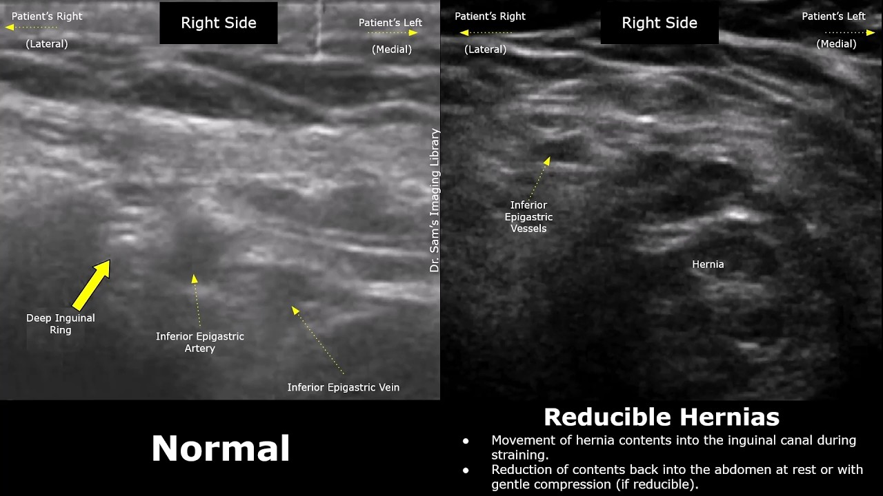 Inguinal Canal Ultrasound Normal Vs Hernia Imaging Findings | Direct ...