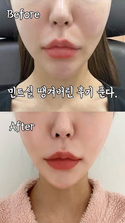 민트실 땡겨버린 후기 민트실리프팅 리프팅시술 실리프팅 리프팅레이저 실리프팅후기 실리프팅전후 실리프팅부작용