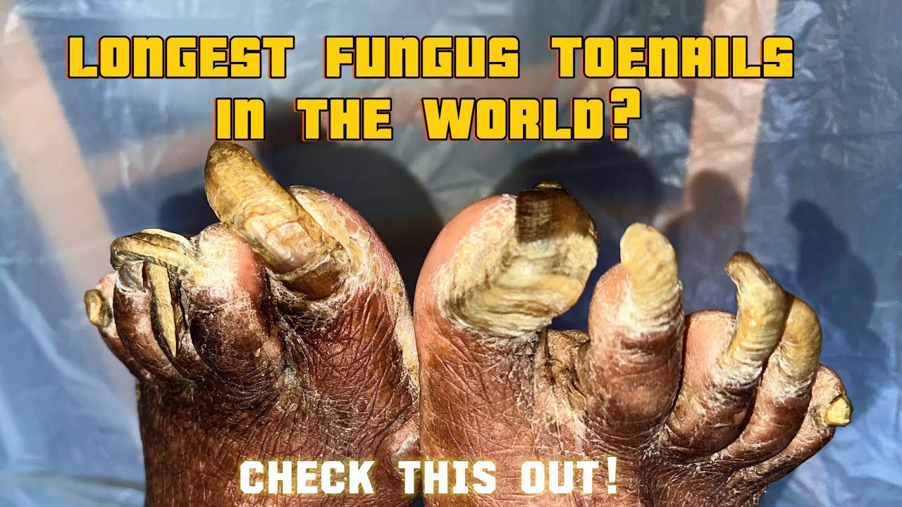 Extremely fungal thickened toenails I Onychogryphosis Transformation ...