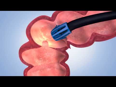 How it Works - Endocuff Vision™ - YouTube