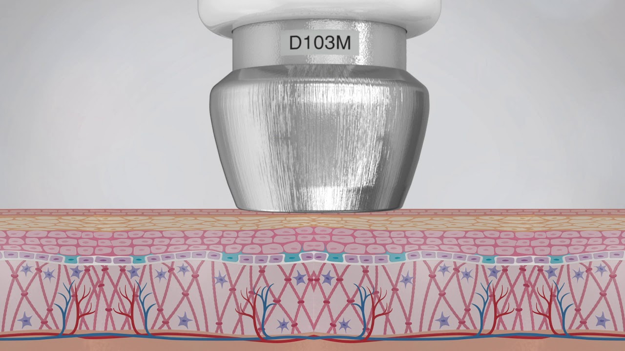 UTIMS Cruise (HIFU+DDU) - YouTube