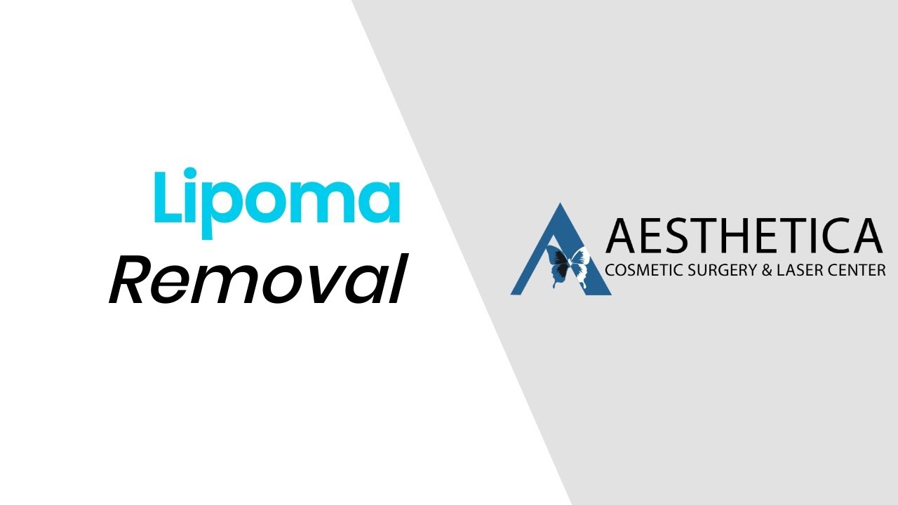 Removal of a Lipoma - YouTube