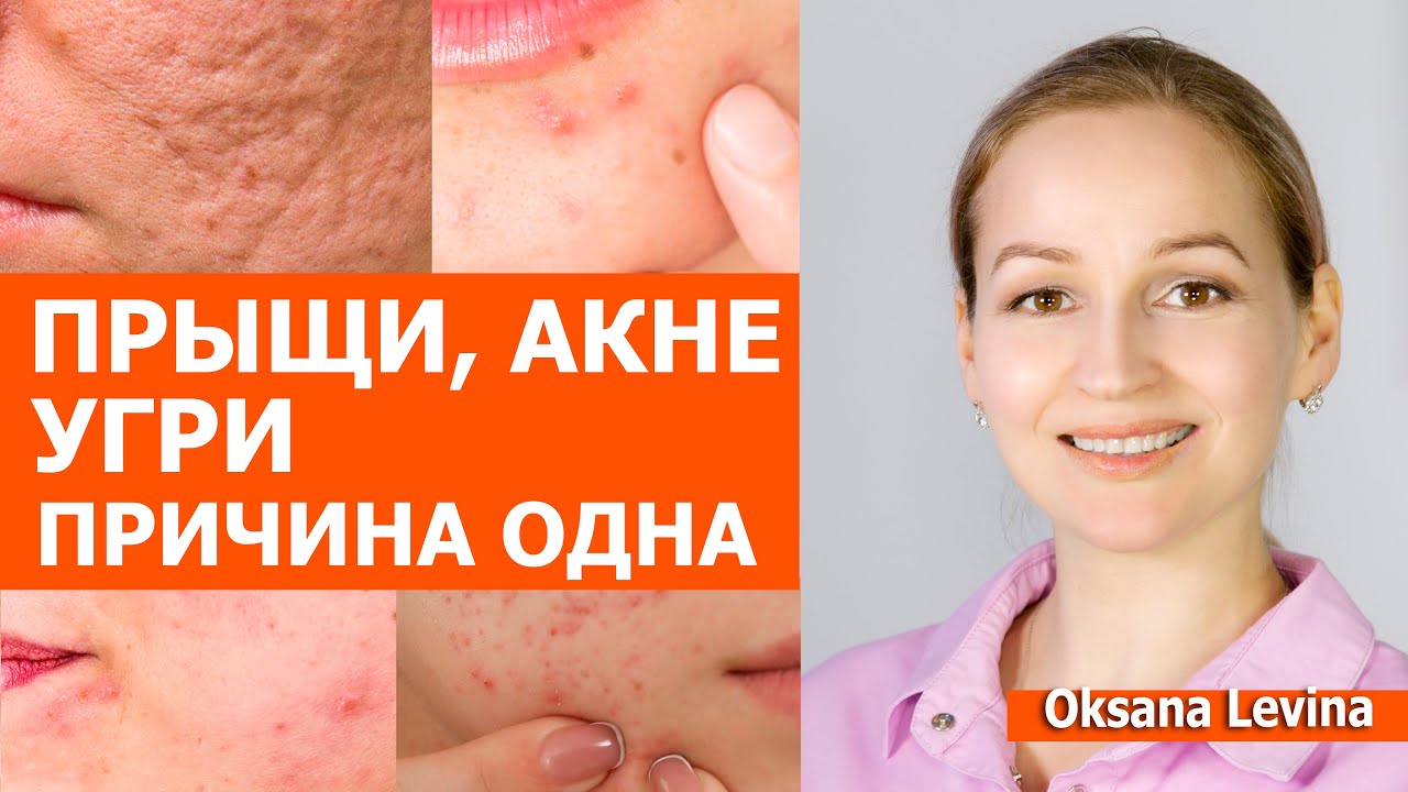 Прыщи угри и акне все дело в еде Как еда влияет на прыщи Youtube