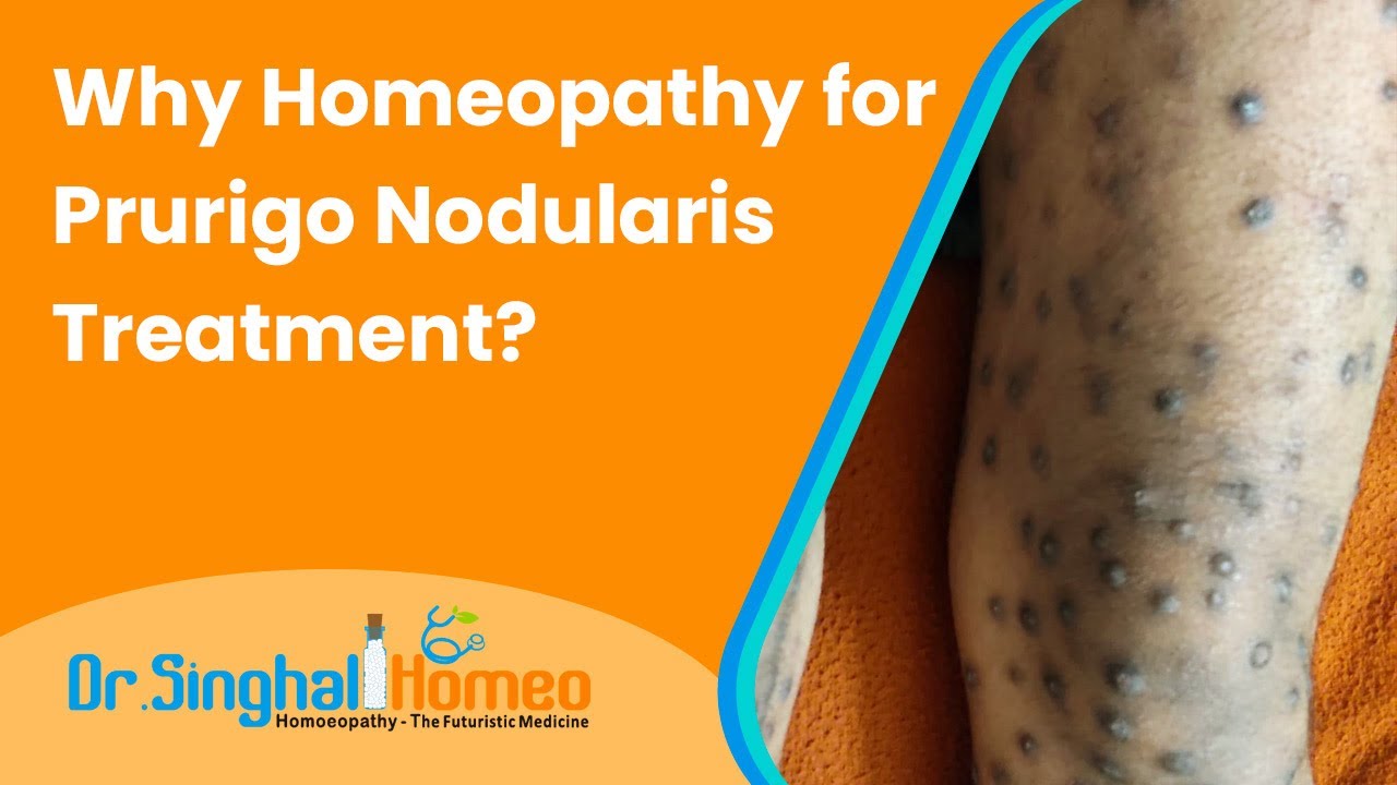 Homeopathic Treatment for Prurigo Nodularis with Effective Results - Dr ...