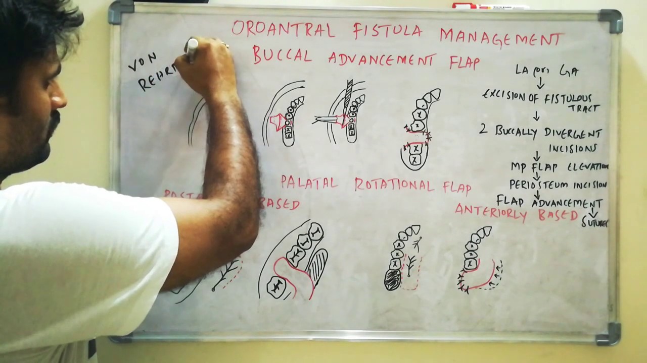 Flaps for oroantral fistula closure - YouTube