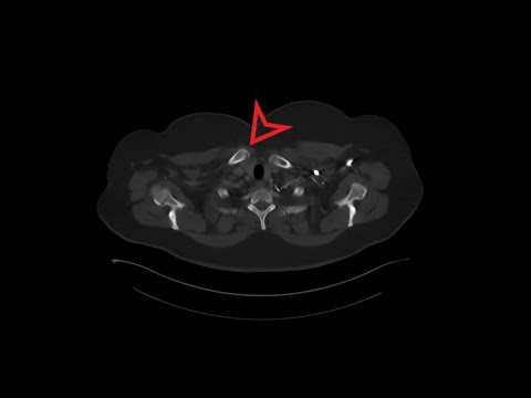 Chest CT: Subtle Right Anterior Sternoclavicular (SC) Dislocation - YouTube