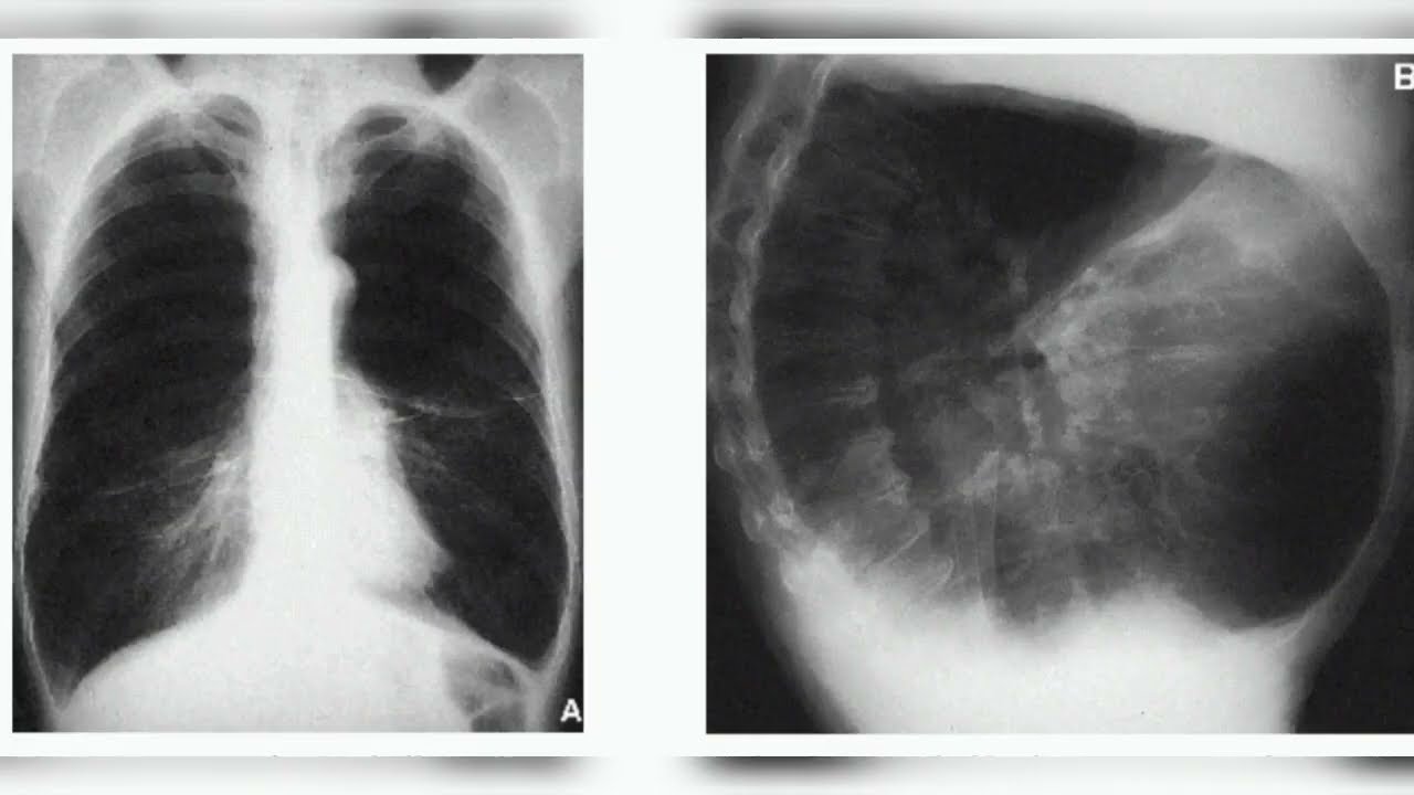 ¿Qué son los pulmones hiperinflados? | Guía de salud | Vidaliax