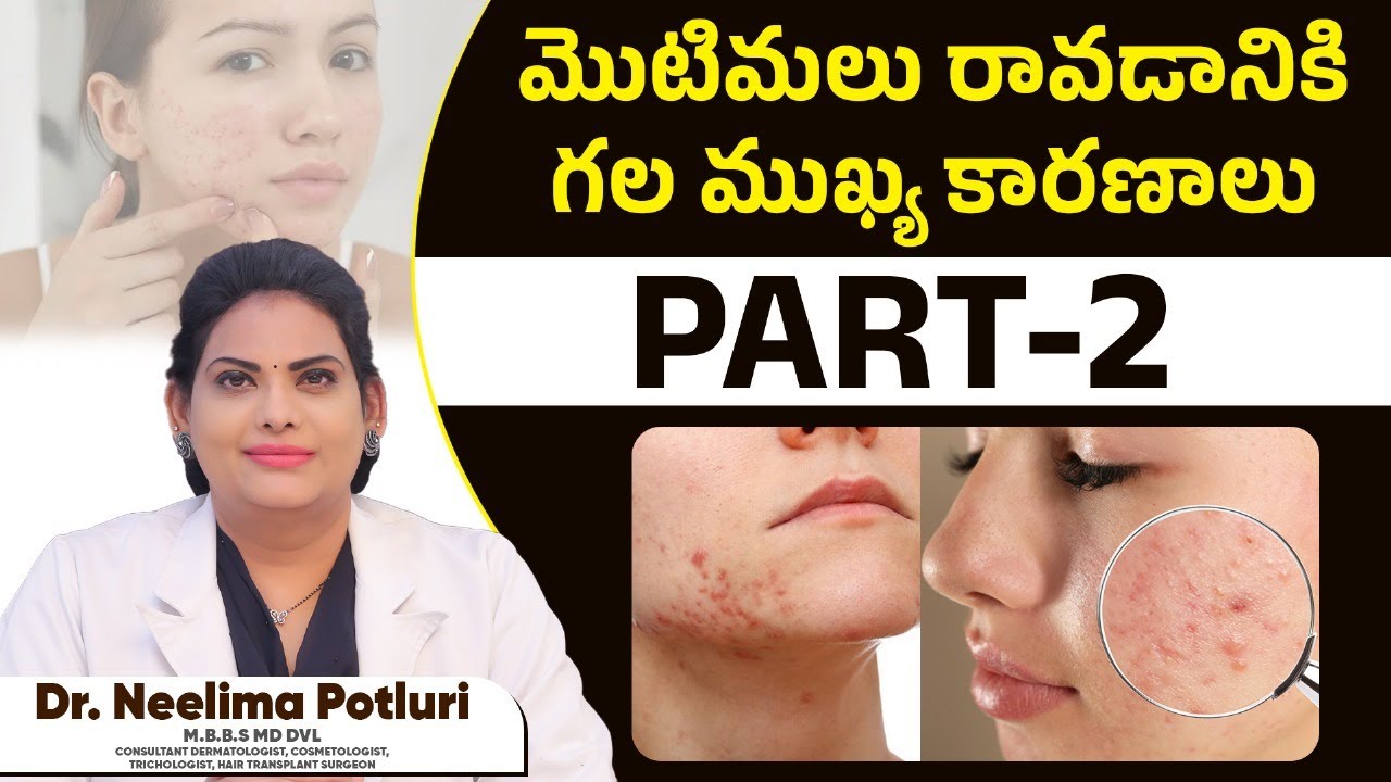 మోటిమలు యొక్క లక్షణాలు || Symptoms & Causes of Acne Vulgaris in Telugu ...