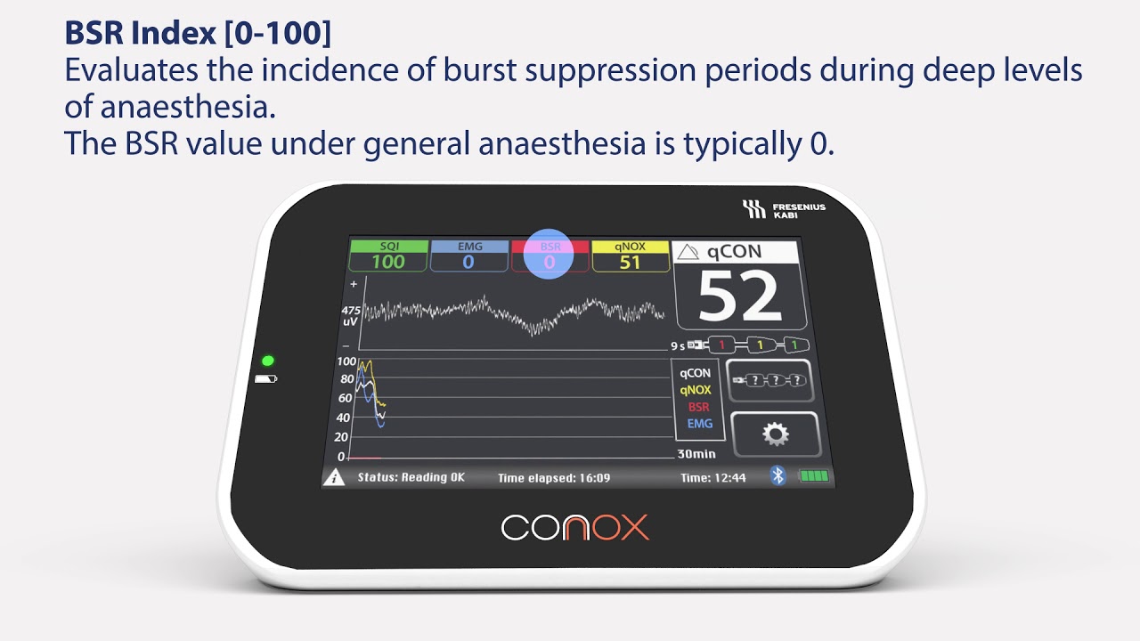 CONOX Smart Anesthesia - YouTube