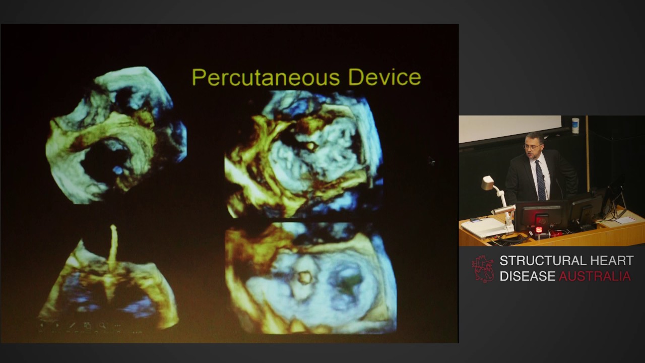 Timing of intervention in mitral regurgitation - Prof Greg Scalia - YouTube