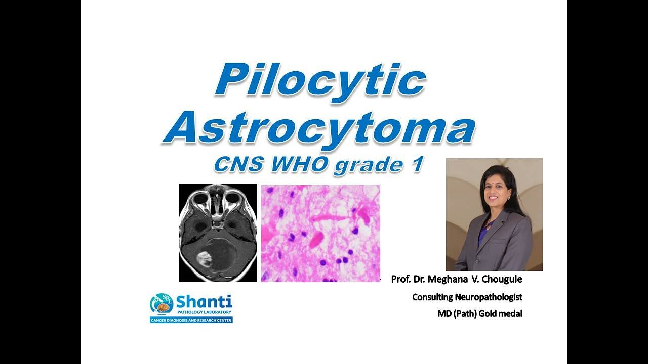 Pilocytic astrocytoma CNS WHO grade 1 - YouTube