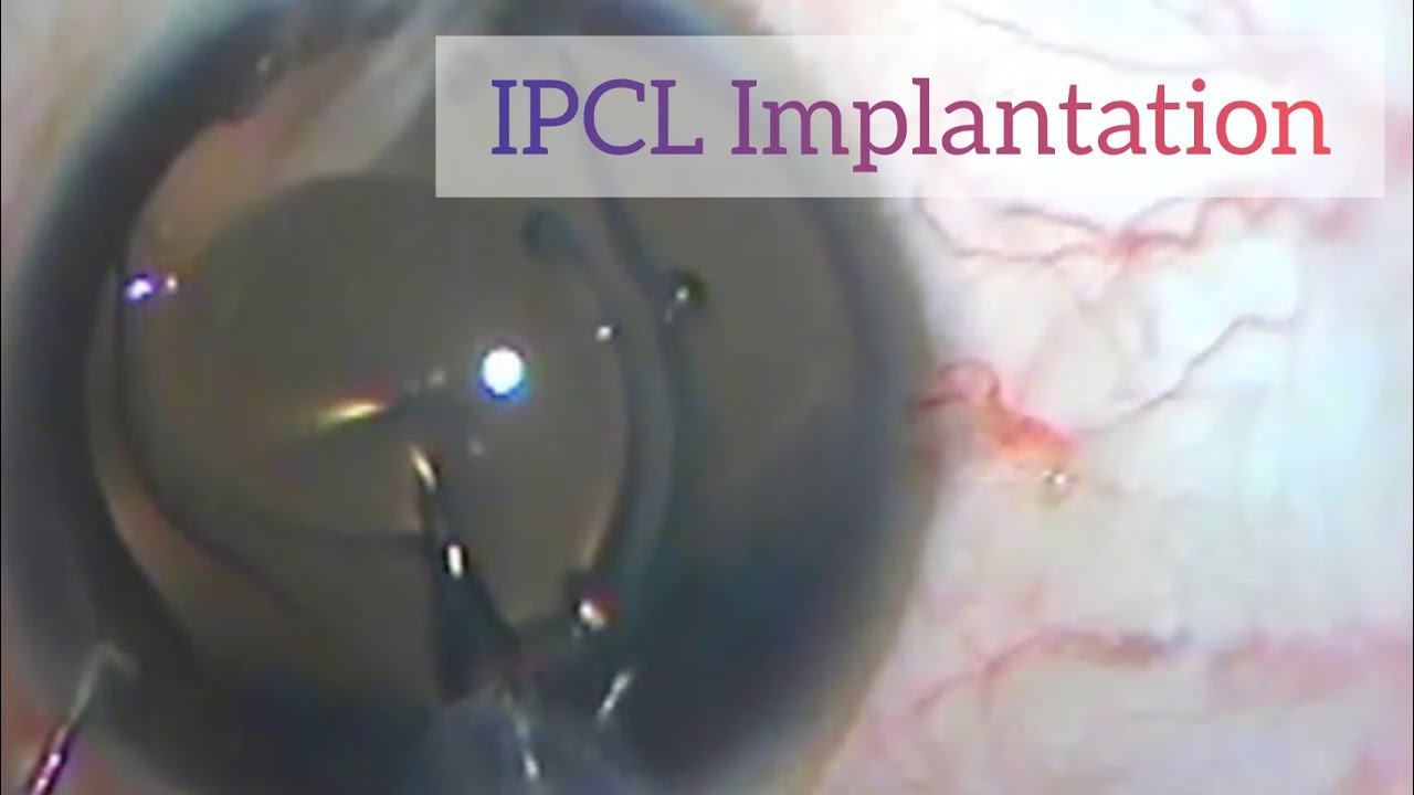 IPCL IMPLANTATION - YouTube