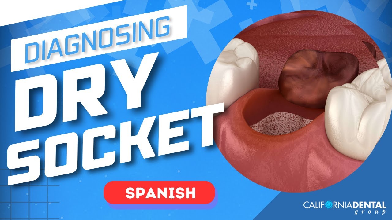 Diagnosing Dry Socket - Spanish - YouTube